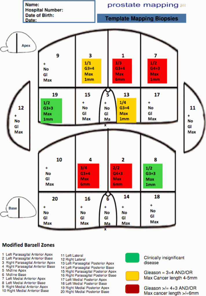 Template Prostate Biopsy Template Prostate Biopsy